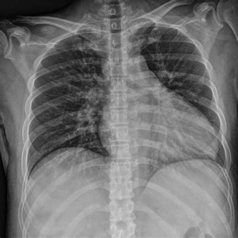 Chest X Ray Antero Posterior Scan On The Day Of Admission Showing No