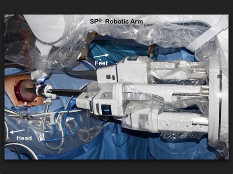 Pure Single Site Robot Assisted Partial Nephrectomy Using The Sp Surgical System Initial