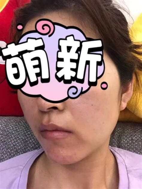 红肿发硬有按压痛的痘痘（没有脓头，就单纯的肿着不冒头）该怎么办？