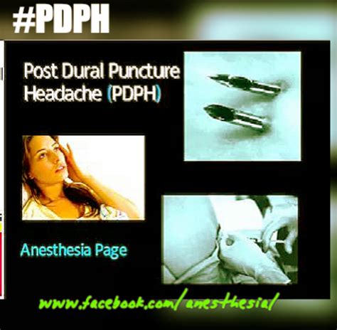 Anesthesia Pdph Updated Post Dural Puncture Headache Facebook