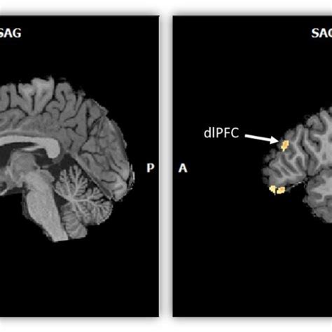 Fmri Images Showing Brain Parametric Activation Associated With Lower