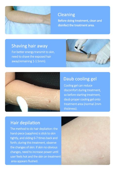 808nm 755 808 1064nm Diode Laser Hair Removal Soprano Model Hebei