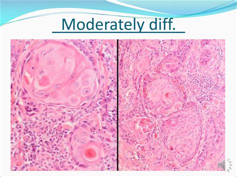 Malignant Neoplasms Dr Reham All 1 Pdf