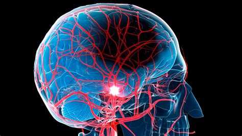 Explore What Is A Stroke Types And Risk Factors