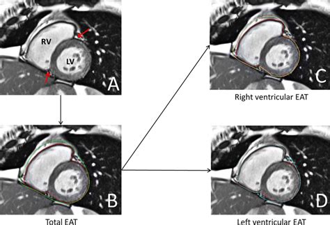 Overview Of Right‐ And Left Ventricular Epicardial Adipose Tissue Eat