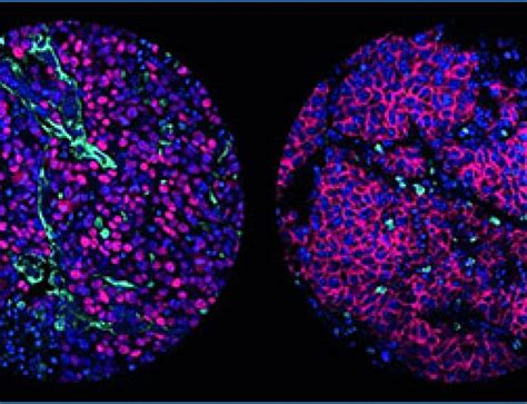 Small Rna Sequencing Of Circulating Micrornas Reveals Novel Biomarkers