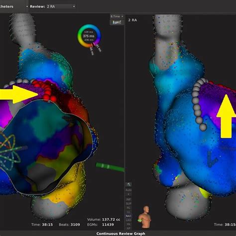 Atrial Flutter Interruption During Radiofrequency Catheter Ablation