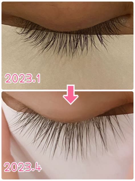 まつ毛美容液emakedエマーキットは効果が強い分、色素沈着する？egutamエグータムとの違いやニセモノの見分け方について