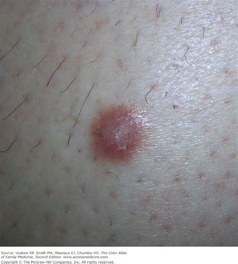Dermatofibroma Basicmedical Key