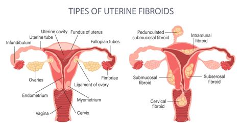 Premium Vector Diagram Of Types Of Uterine Fibroids In A Woman Healthy And Unhealthy Uterus