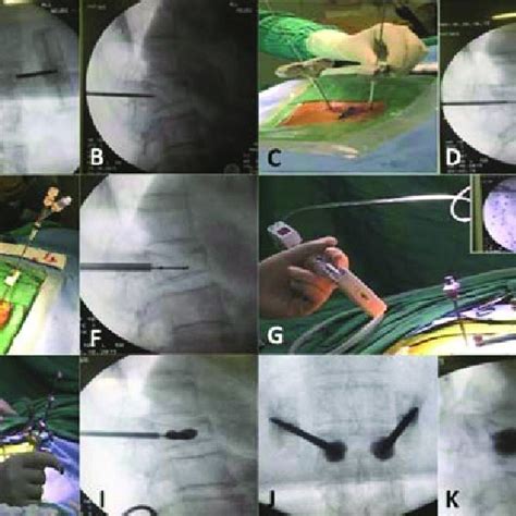 Sequential Steps In Kyphoplasty Procedure A B X Ray Anteroposterior