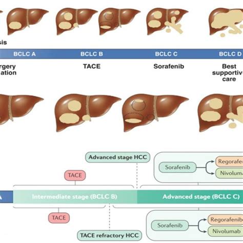 Hcc Treatment Related To Stages Ahmad Et Al 2019 Bclc The