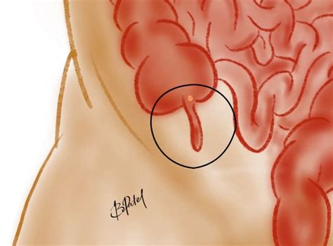Human Appendix Inflamed Advantages Of Laparoscopic Appendectomy
