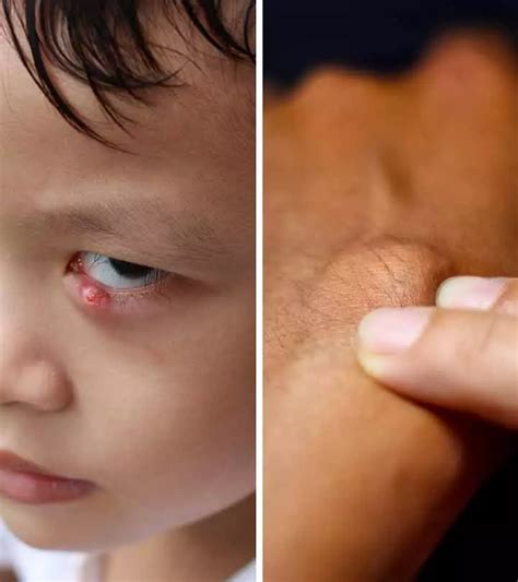 Fingertip Peeling Causes Remedies And Prevention