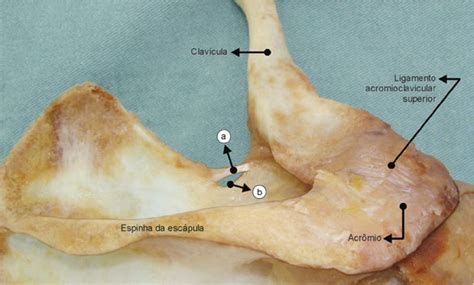 Ligamento Transverso Da Escapula