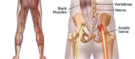 Are Inversion Tables Good For Sciatica Women Daily Magazine