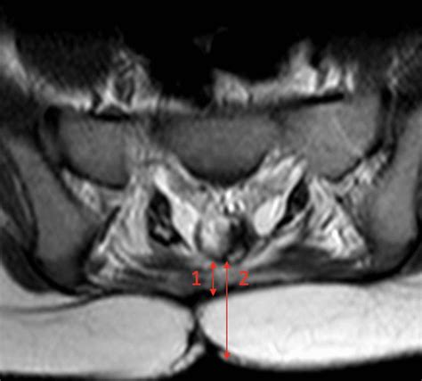 subcutaneous tissue measurements distances from neural tissue to