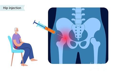 Hip Joint Injection Photograph By Pikovit Science Photo Library