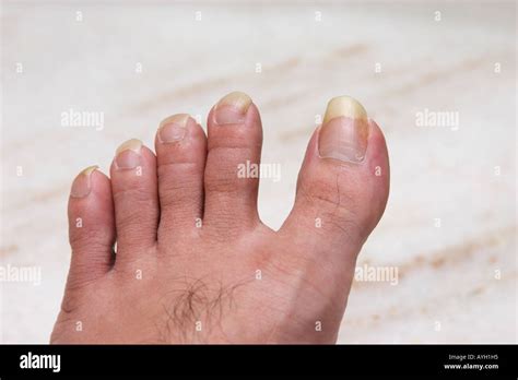 Long Toenails Clawing Back Telegraph
