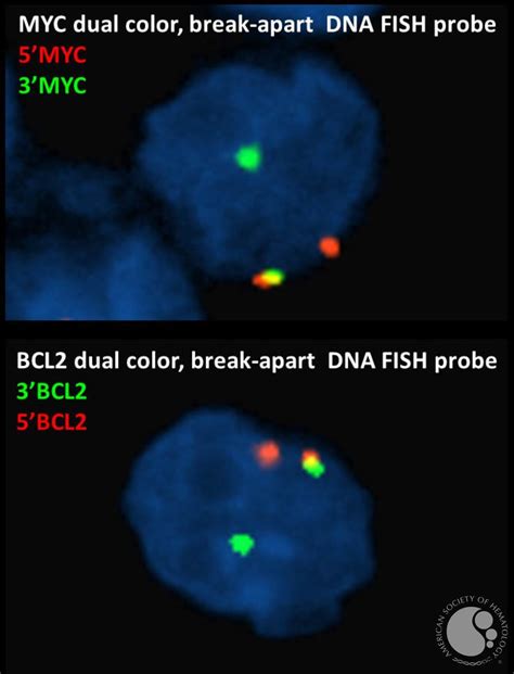 Double Hit Lymphoma Fish