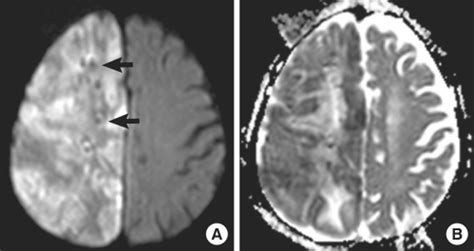 Brain Mri Diffusion Weighted Brain Mr Imaging A Demonstrated Diffuse