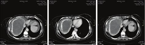 An Abdominal Ct Scan Demonstrated Multiple Hepatic Masses In The Right