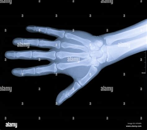 X Ray Of Arm