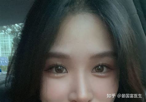 关于眉弓最常见的5个问题，你一定要知道！ 知乎