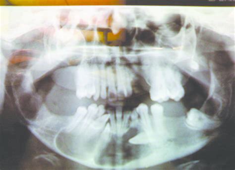 X Ray Showing Multiple Odontogenic Cyst Download Scientific Diagram