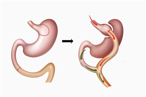 Roux En Y Gastric Bypass Roux En Y Gastric Bypass In Sthelier