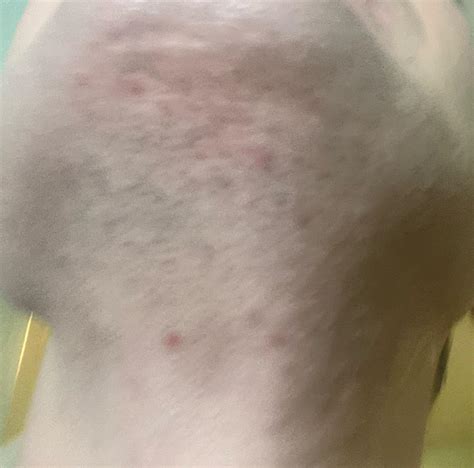 Need Help W Beard Rash Rmedicaladvice