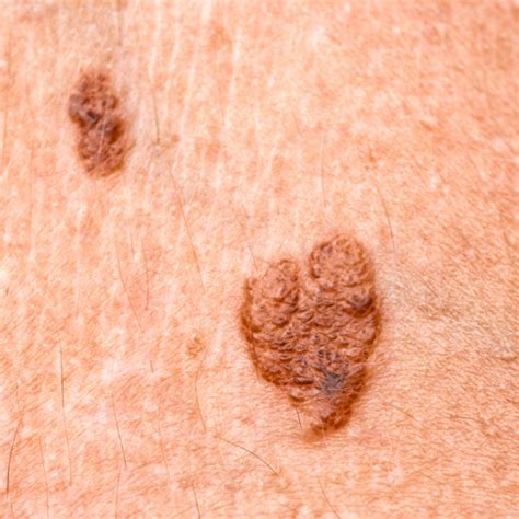 Why Remove Moles Lumps And Bumps Enigma