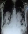 Diffuse Dermal Angiomatosis Of The Breast Two Case Reports And Literature SAJ Case Reports