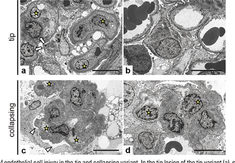 Figure 2 From Diverse Alterations Of Glomerular Capillary Networks In Focal Segmental Glomerular