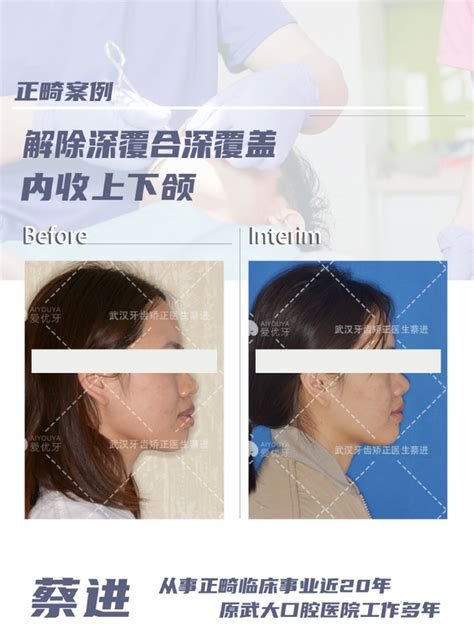 武汉牙齿矫正丨隐适美矫正中 中度深覆合深覆盖 知乎