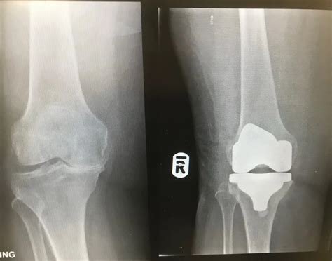 Mr Shah Punwar Expert Hip And Knee Orthopaedic Surgeon Opening