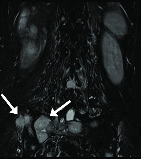 Spinal Metastasis This 53 Year Old Woman With A Remote History Of