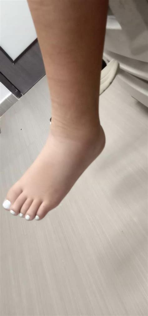 Sprained Ankle Rsprainedankles
