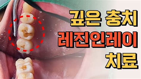 3d스캐너를이용한깊은충치레진인레이 풀영상 공장장조카이빨출연 치과 Asmr Youtube