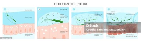 Processus Dinfection À Helicobacter Pylori Dans La Muqueuse De Lestomac