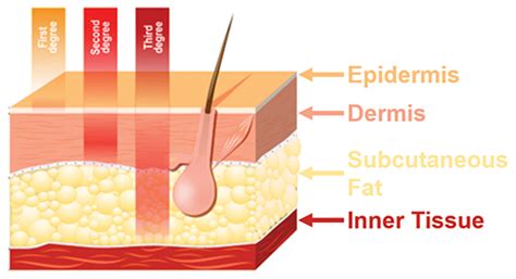 Reduced Order Modeling Of Pennes Bioheat Equation For Thermal Dose Analysis In Compliance