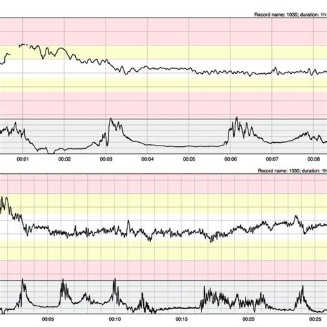 A Segment Of Ctg Recording From An Open Access Intrapartum Ctg Database