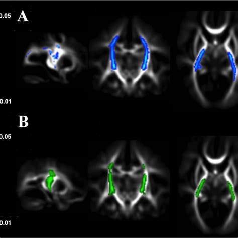 Punctate White Matter Lesions Are Associated With Altered White Matter