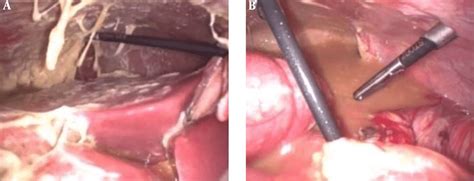 Generalized Peritonitis With Diffuse Effusion In Subdiaphracmatic Download Scientific Diagram