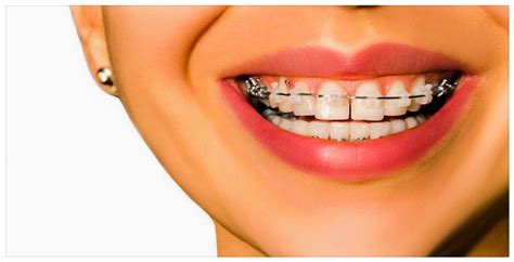 3 Super Easy Ways To Floss With Braces Buddha Dental Tree