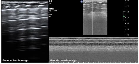 Protocol And Guidelines For Point Of Care Lung Ultrasound In Diagnosing