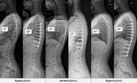 Case Demonstration For Each Sagittal Modifier In Lenke Type 1 Cases