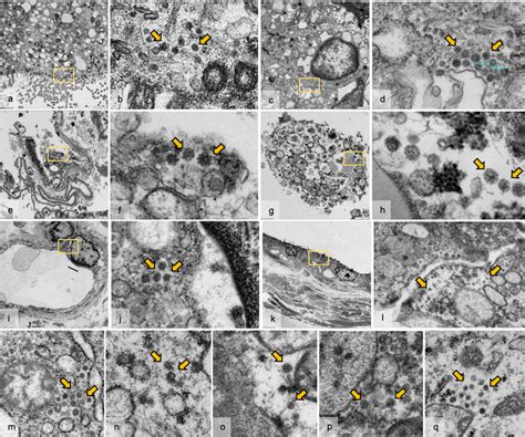 Electron Microscopy Findings Olfactory Mucosa A D Ciliated