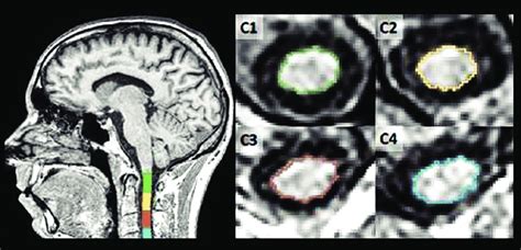 Spinal Cord Segmentation And Quantification With Icobrain™ To Assess