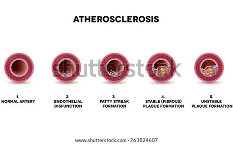 Atherosclerosis Formation Healthy Artery Unhealthy Arteries